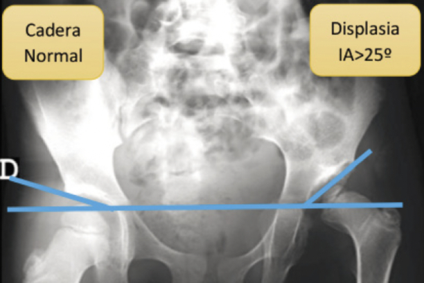 Tratamiento de displasia del desarrollo de la cadera | Dr. Jorge ...